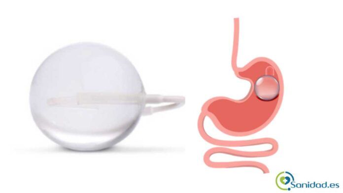 Los mejores beneficios del balón gástrico ajustable | Sanidad.es